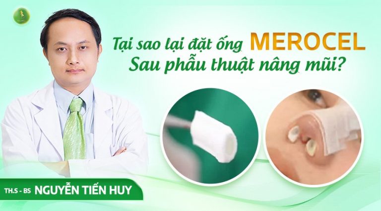 TẠI SAO LẠI ĐẶT ỐNG MEROCEL SAU NÂNG MŨI? – Nâng mũi cấu trúc sụn sườn ...